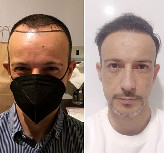 SinOcap – Injerto capilar